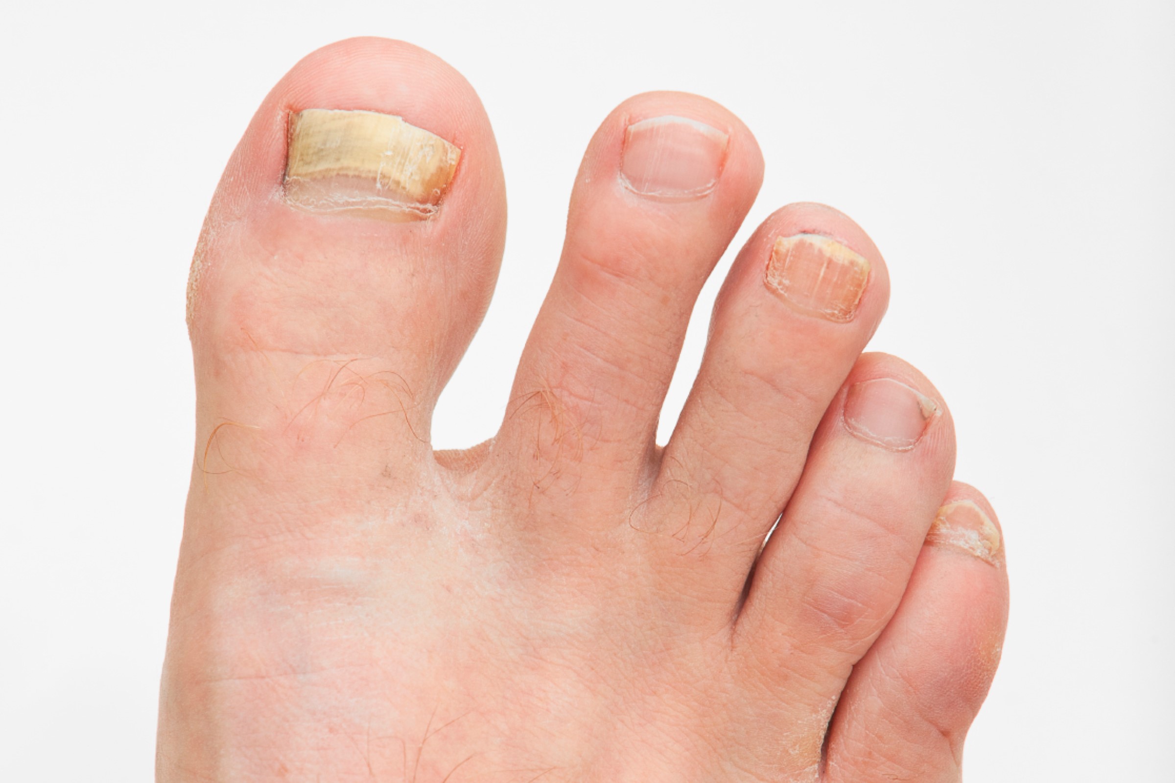 Neglesopp - helsenorge.no