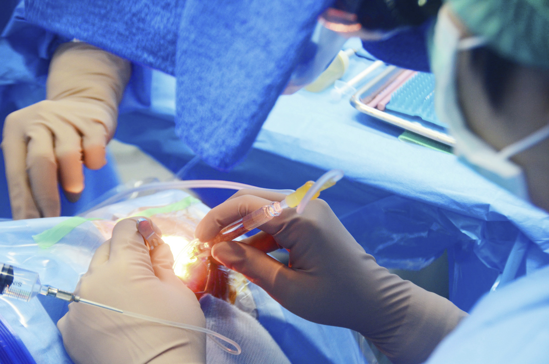 Grå stær (katarakt) - helsenorge.no